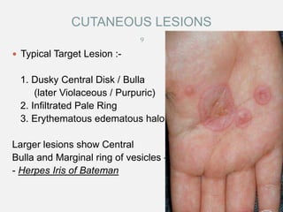 Erythema Multiforme Target Lesions