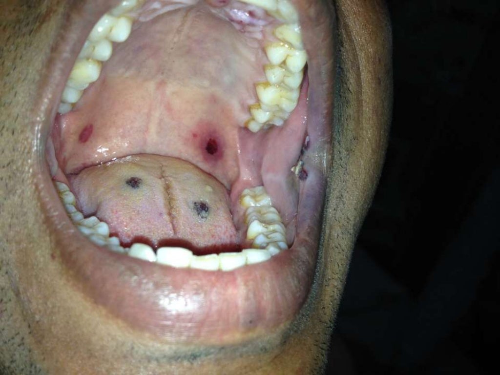 Erythema multiforme by aseem