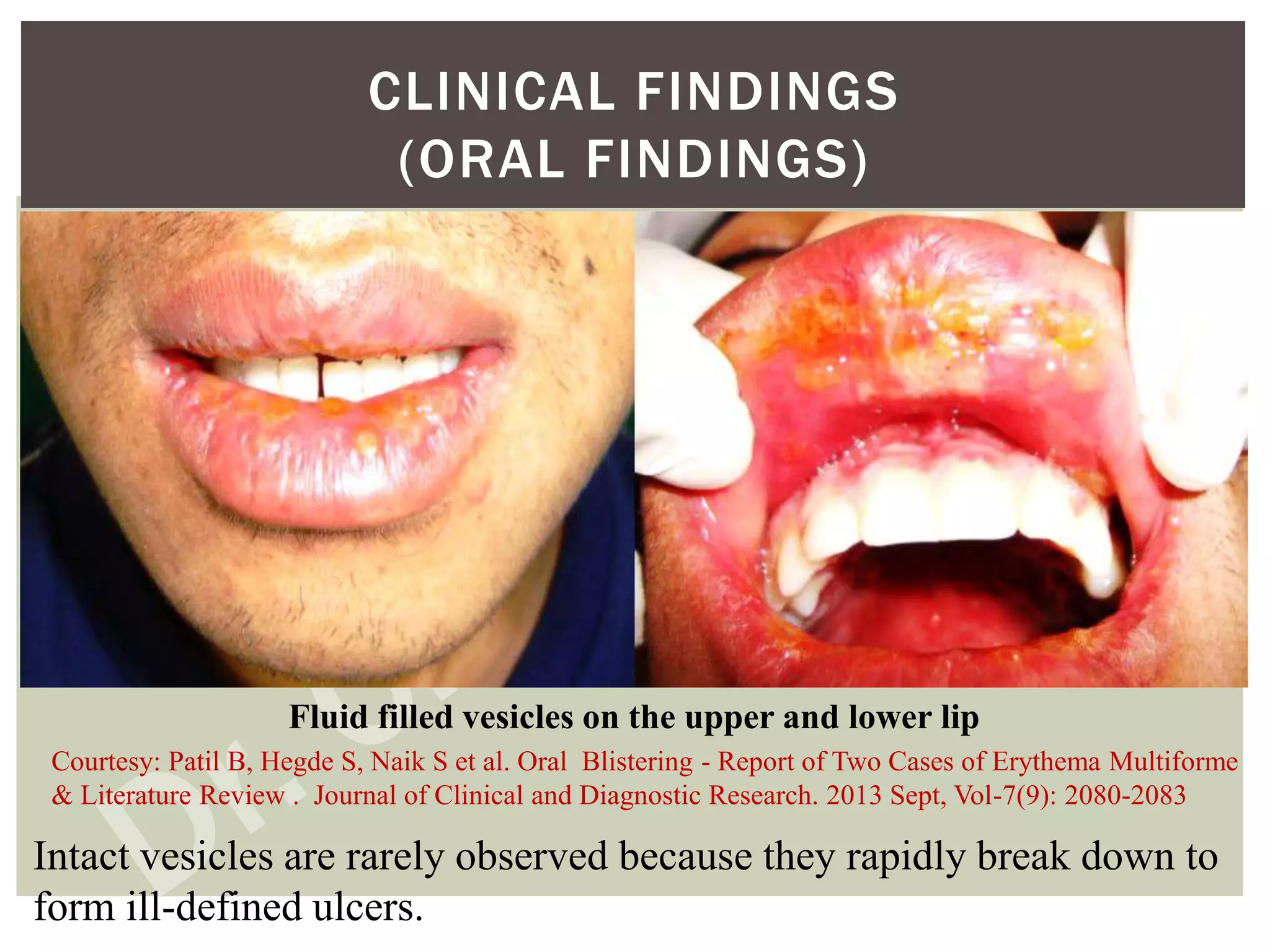 Erythema multiforme Dr Chithra P | PPT