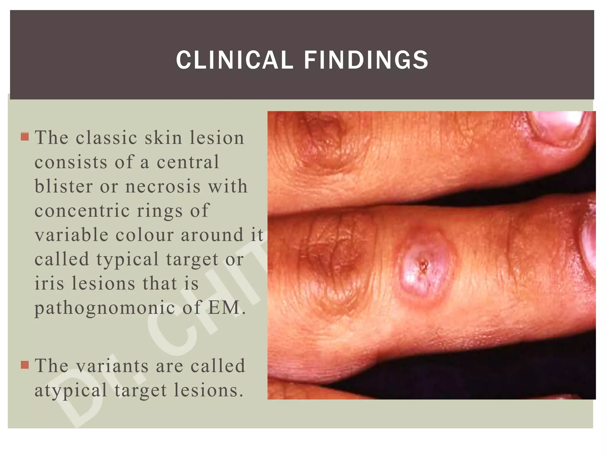 Erythema multiforme Dr Chithra P | PPT