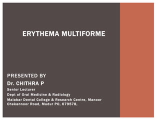 Erythema Multiforme Oral Histology