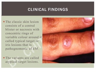 Erythema Multiforme Target Lesions