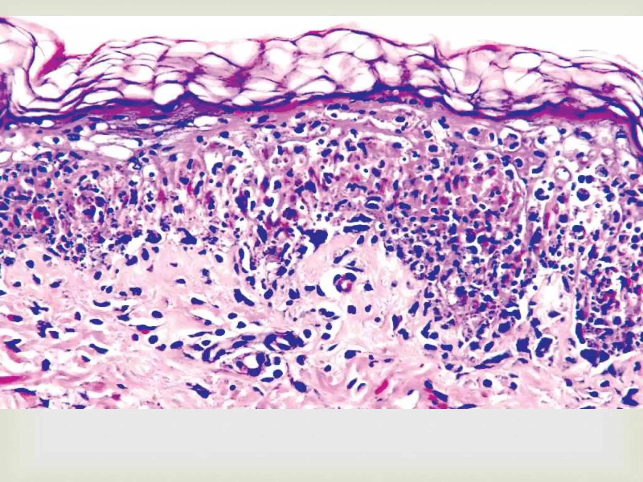 Erythema multiforme, Steven-Johnson syndrome and Toxic Epidermal ...