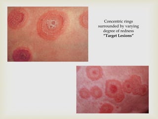 Erythema Multiforme Target Lesions