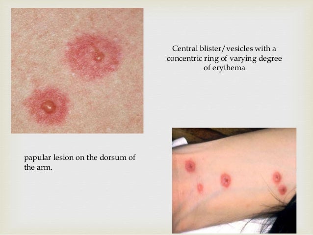 Erythema Multiforme Orale Histologie