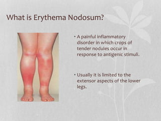 Erythema Nodosum