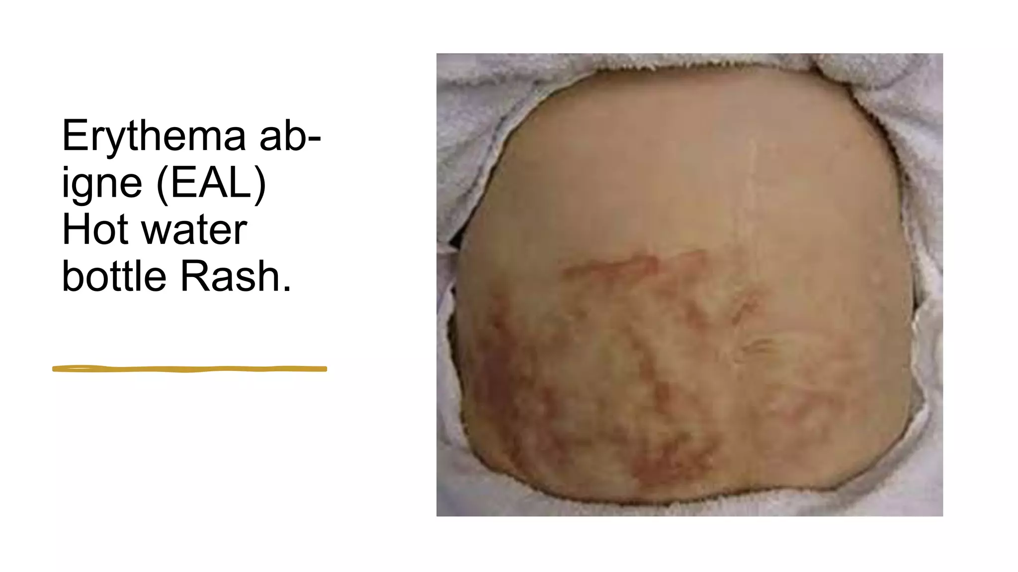 Erythema (redness of skin) | PPTX