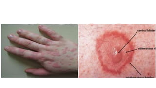Erythema (redness of skin) | PPTX