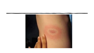 Erythema (redness of skin) | PPTX