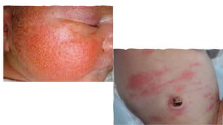 Erythema (redness of skin) | PPTX