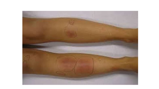 Erythema (redness of skin) | PPT