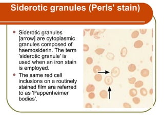 Siderotic Granules