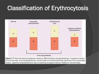 Erythrocytosis (Polycythemia),,Ghidaa.pptx | Blood Disorders | Diseases ...