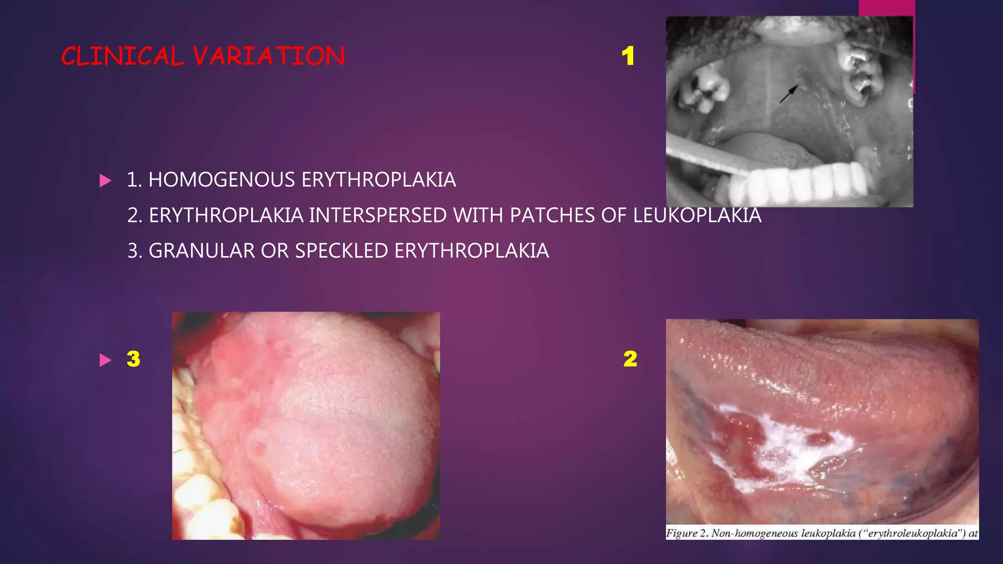 Erythroplakia | PPTX