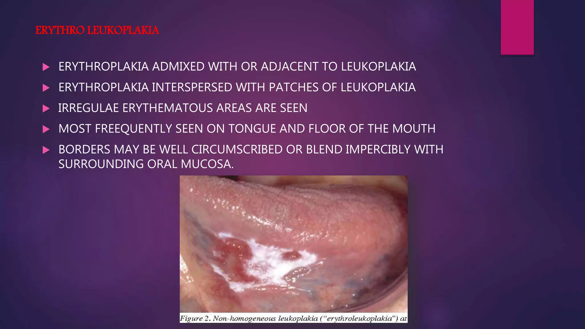 Erythroplakia | PPTX