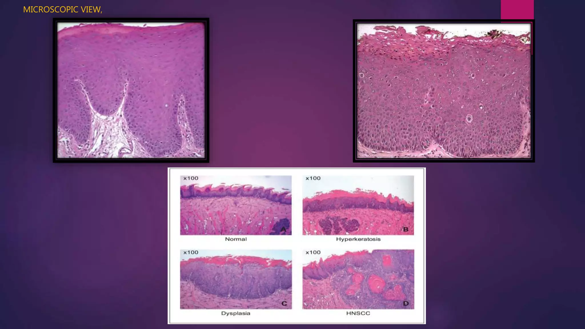 Erythroplakia | PPTX
