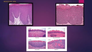 Erythroplakia Histopathology