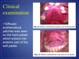 Erythroplakia - | PPTX