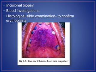 Erythroplakia - | PPTX