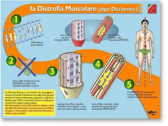 La Distrofia Muscolare di Duchenne | PPTX