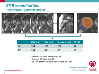 Assessment of Aortic Regurgitation with Cardiovascular Magnetic ...