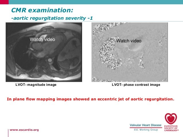 Assessment of Aortic Regurgitation with Cardiovascular Magnetic Reso… Assessment of Aortic Regurgitation with Cardiovascular Magnetic Reso…