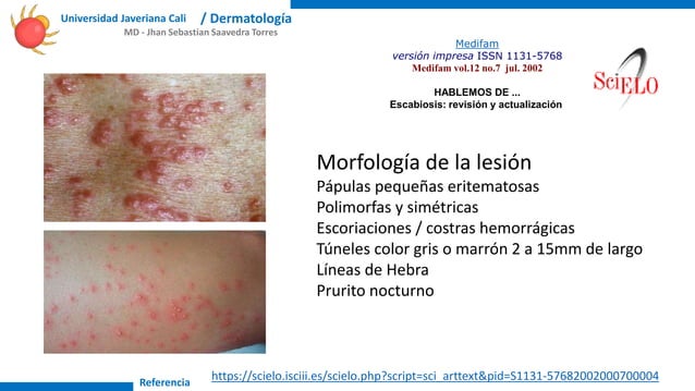 Escabiosis es la infestación de la piel con el ácaro Sarcoptes scabiei.