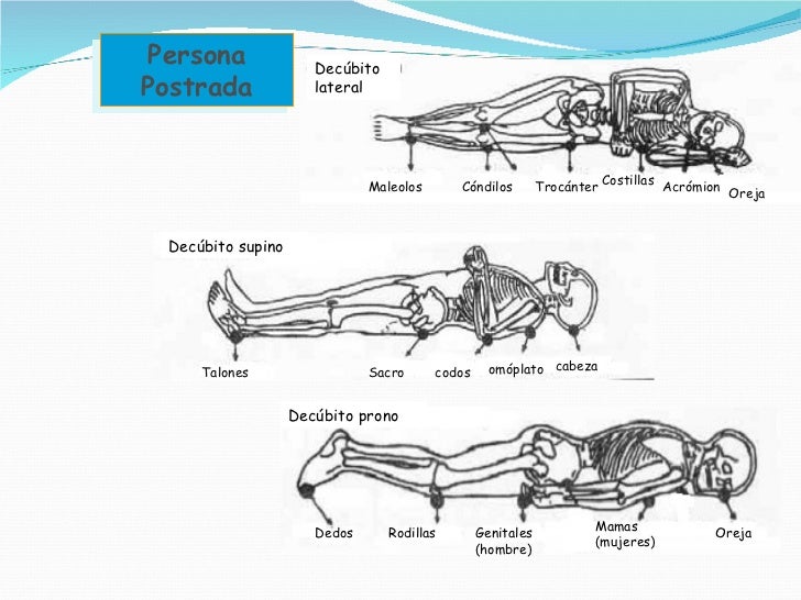 Úlceras por Decúbito su Prevención y tratamiento