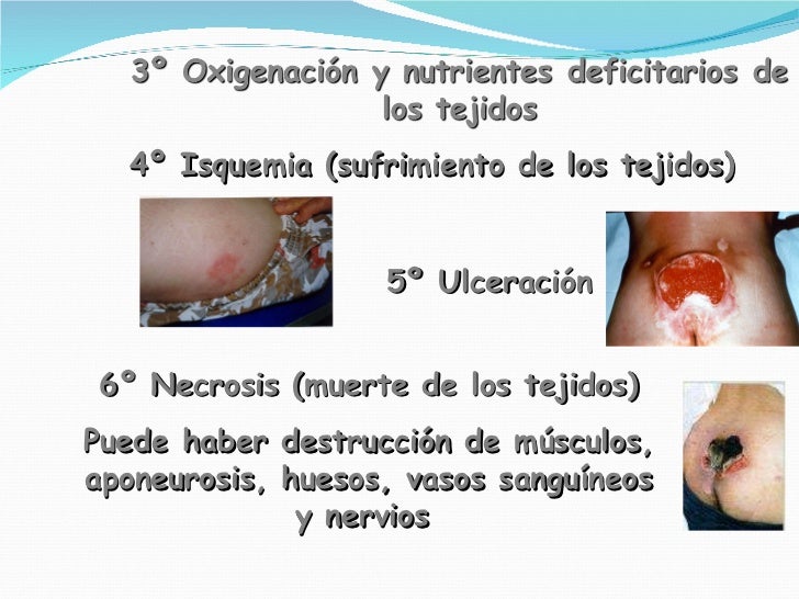 Úlceras por Decúbito su Prevención y tratamiento