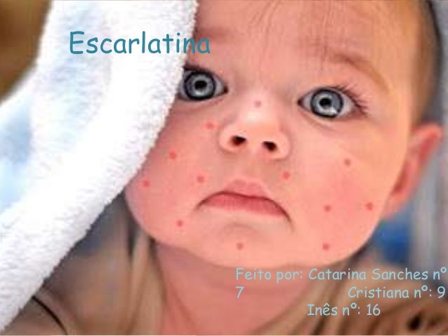 Escarlatina