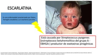 Estreptococos Del Grupo A Escarlatina