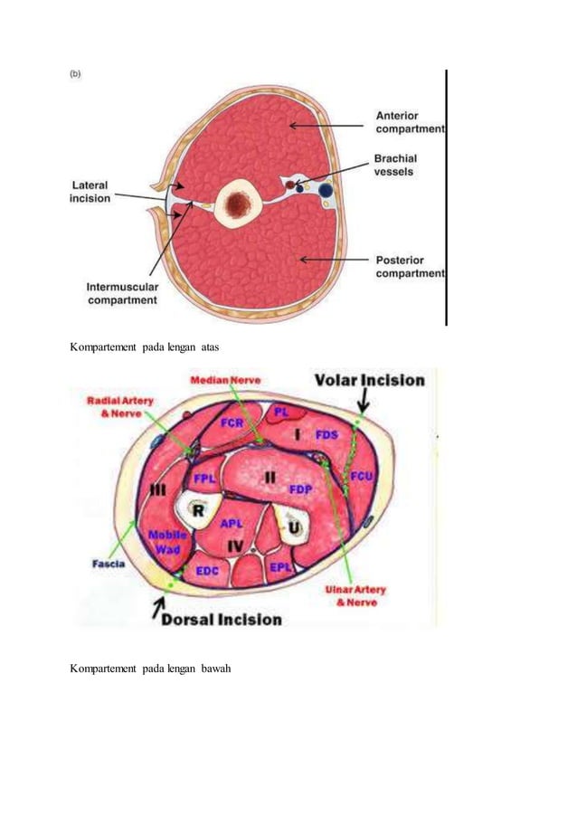 Escarotomy, Escarectomy, Burn , combustio | DOCX