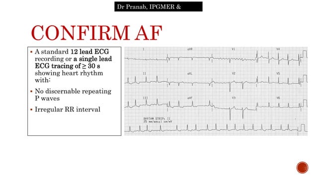 Esc guideline for atrial fibrillation 2020 [dr pranab] | PPT