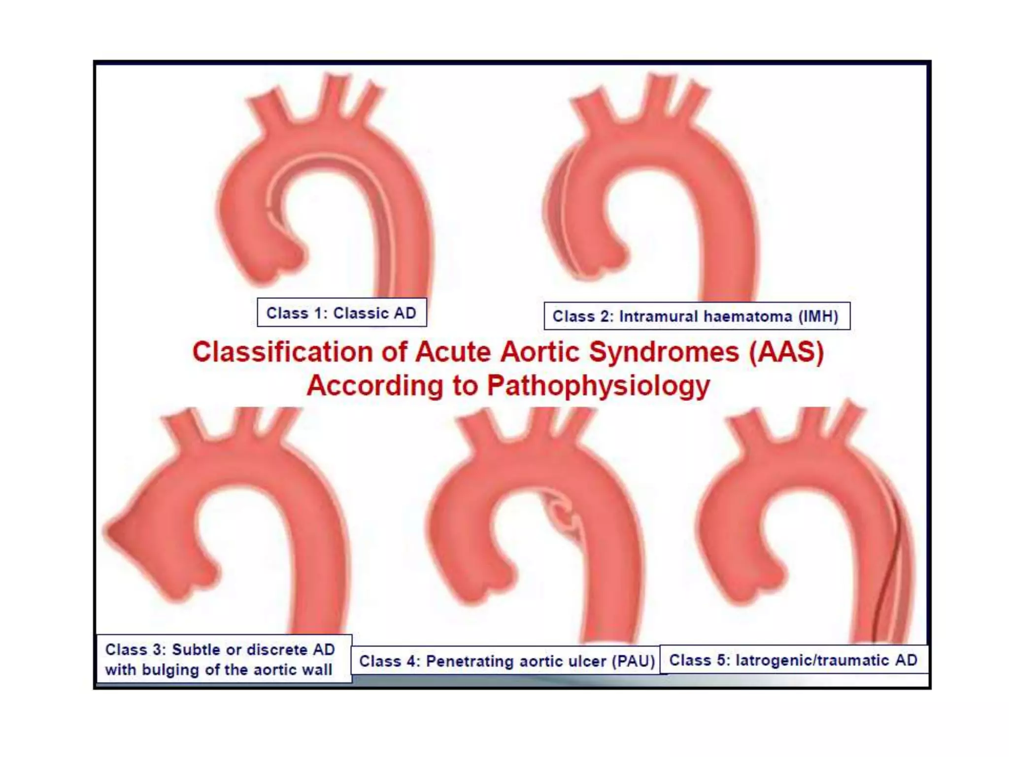 2014 ESC guidelines aortic diseases | PPTX
