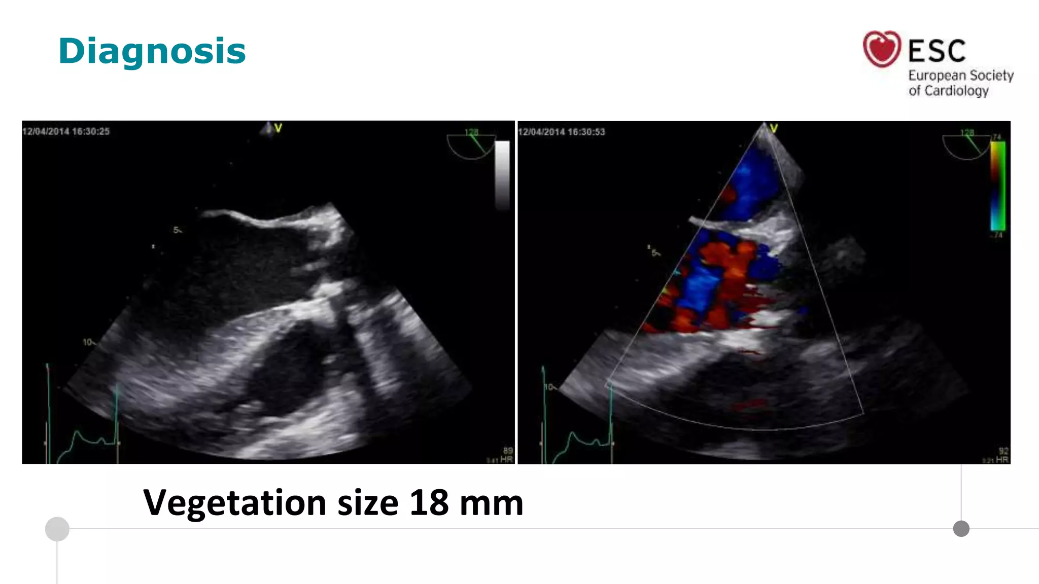 Esc guidelines endocarditis by prof deldago | PPTX