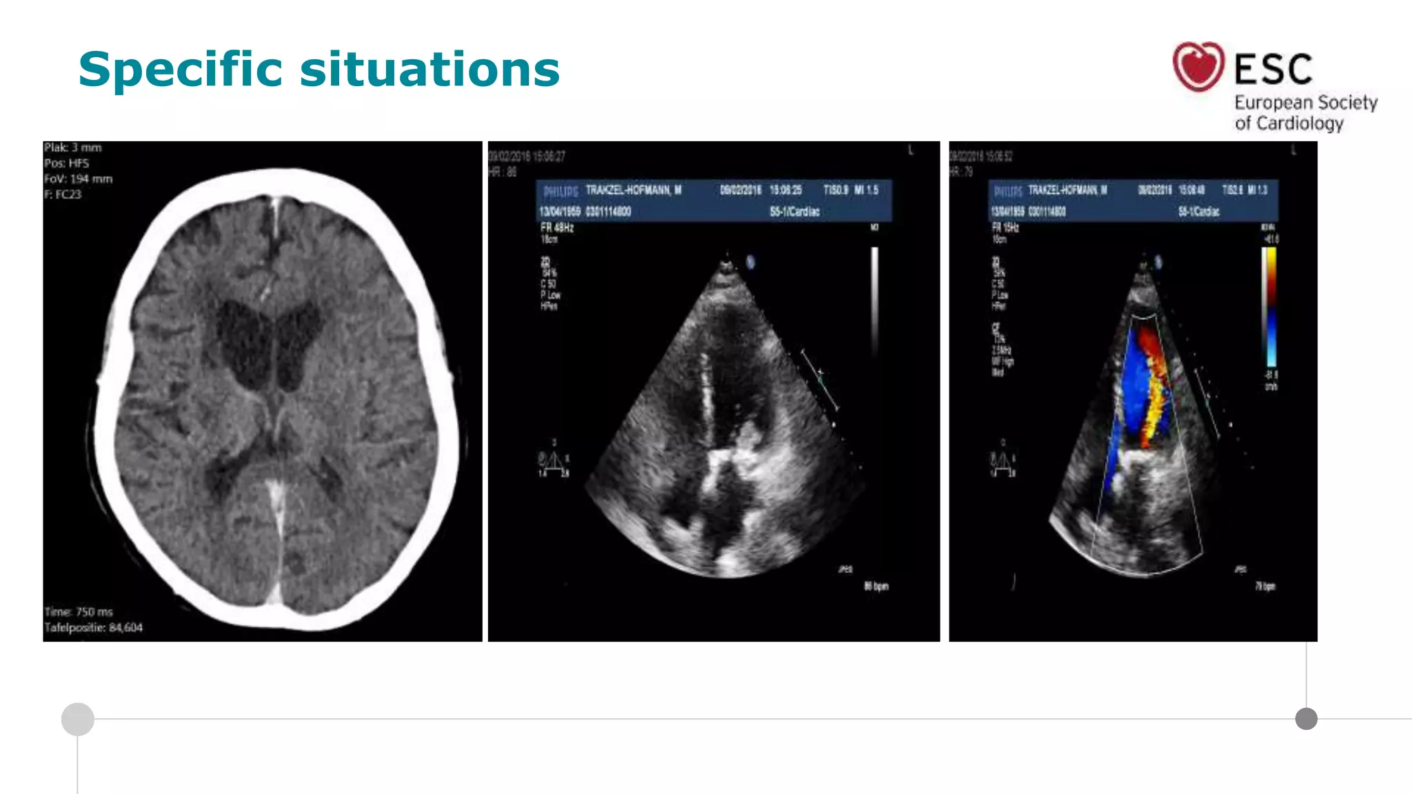 Esc guidelines endocarditis by prof deldago | PPTX