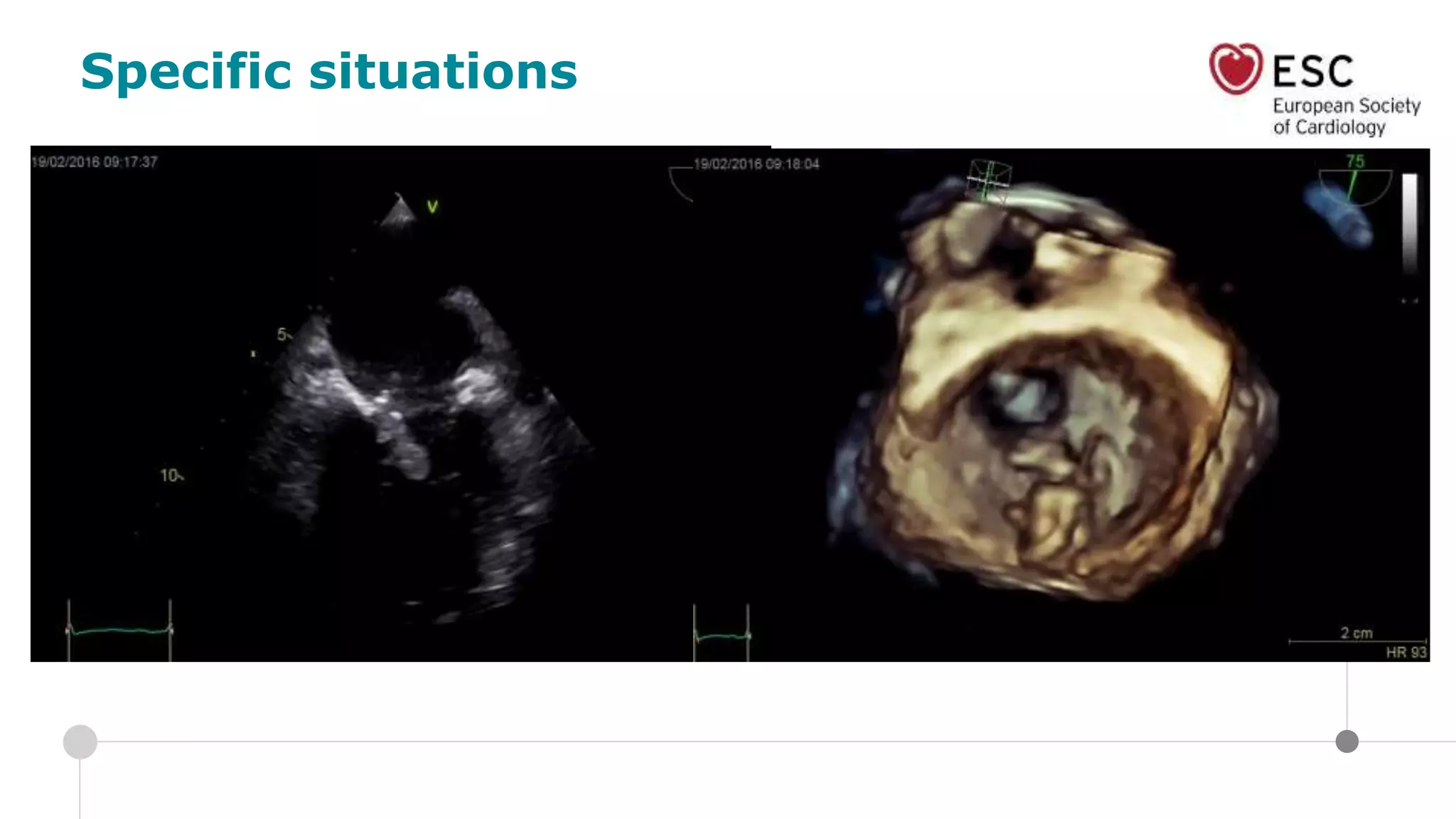 Esc guidelines endocarditis by prof deldago | PPTX