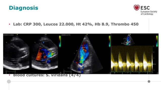 Esc guidelines endocarditis by prof deldago | PPTX | Heart and ...