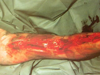 Escharotomy | PPT