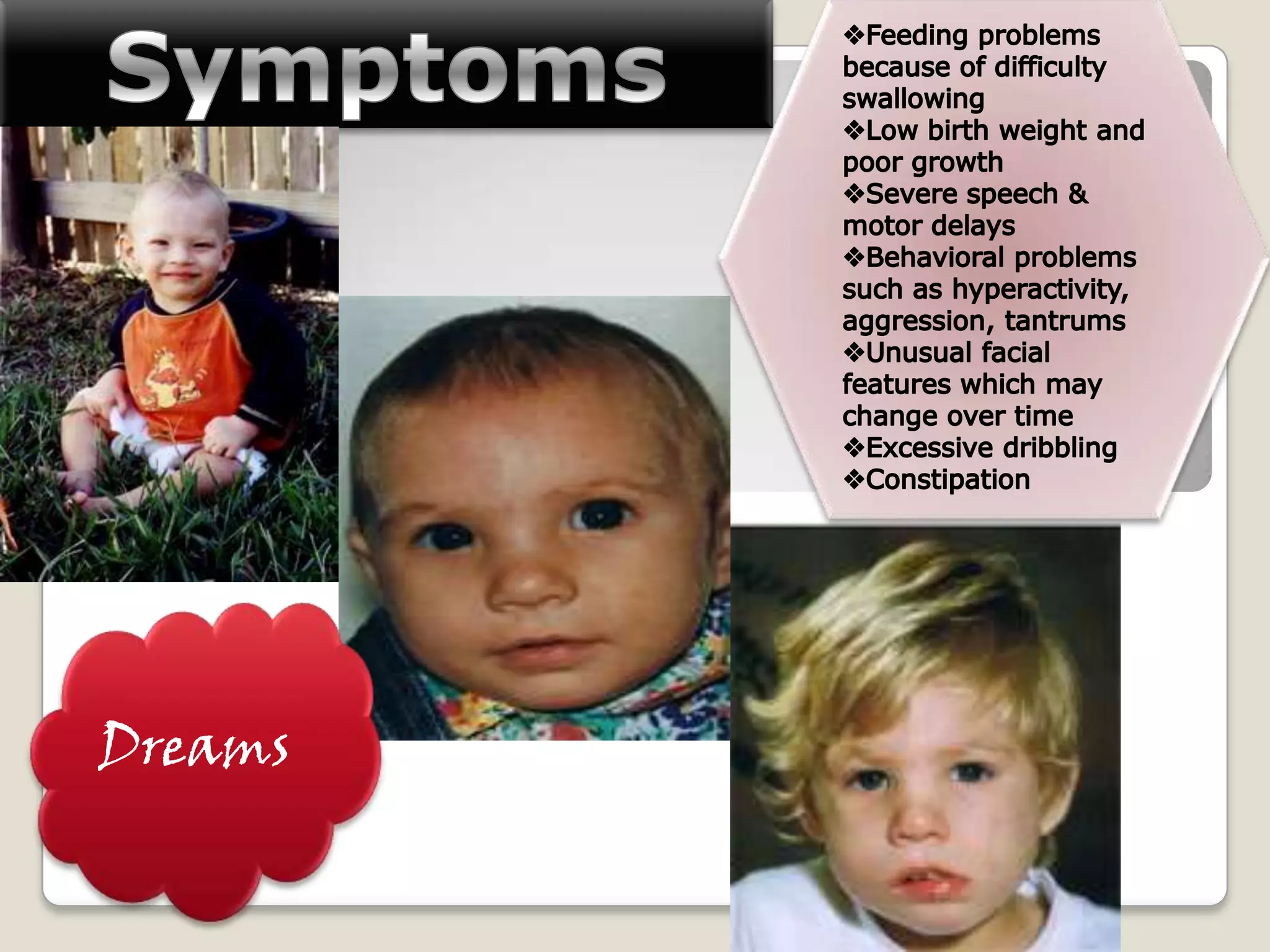 Cri Du Chat Syndrome | PPTX