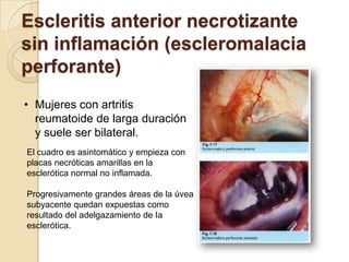 Escleritis | PPTX
