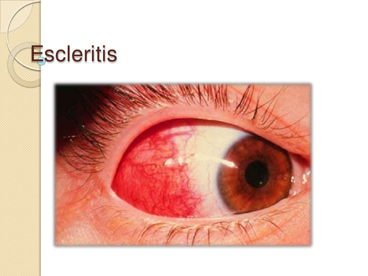 Escleritis