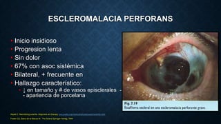 Escleritis | PPT