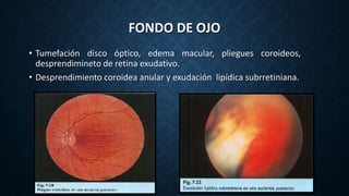 Escleritis | PPT | Diseases and Conditions | Medical Health