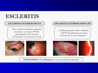INFLAMACION DE CAPAS DE LA ESCLERA: ESCLERITIS | PPT