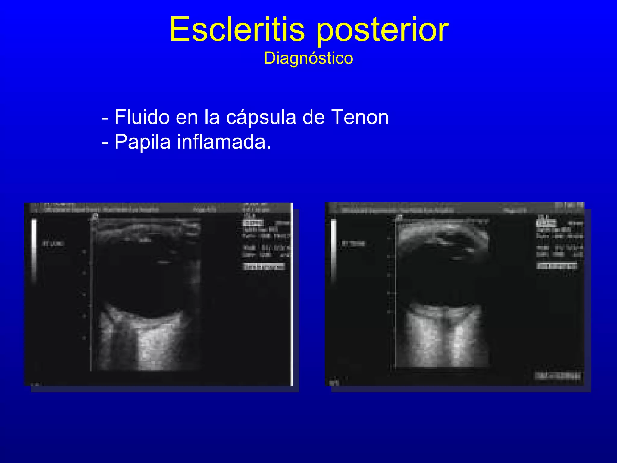 Oftalmologia - Escleritis Posterior | PPT | Eye and Vision Conditions ...