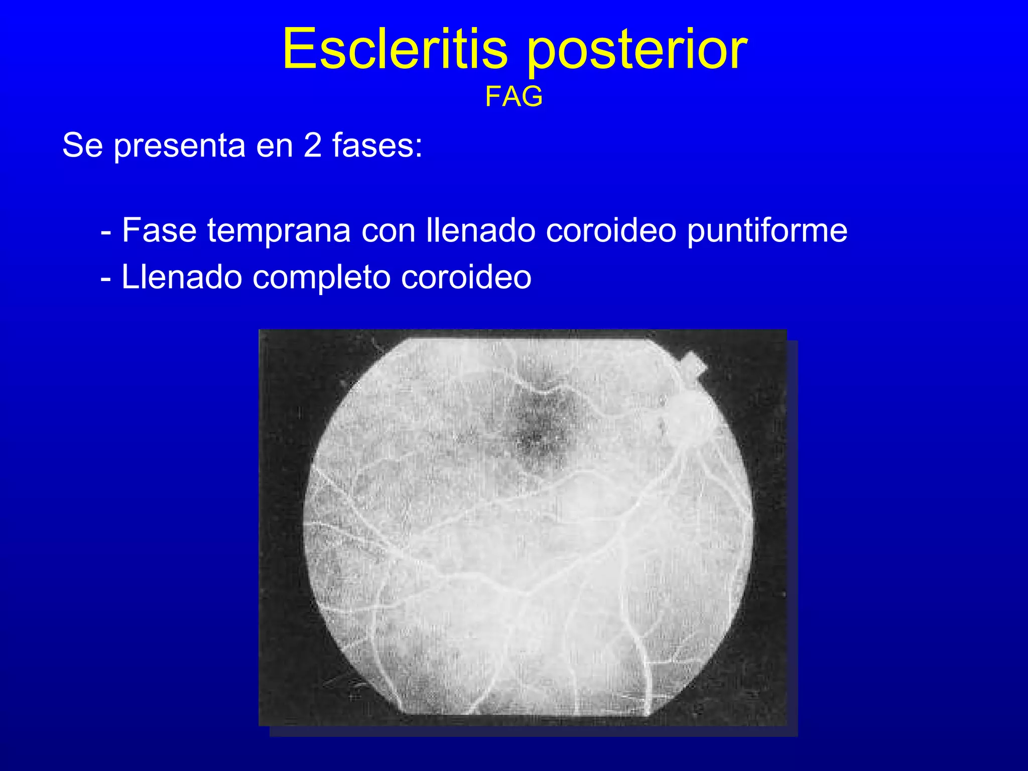 Oftalmologia - Escleritis Posterior | PPT | Eye and Vision Conditions ...