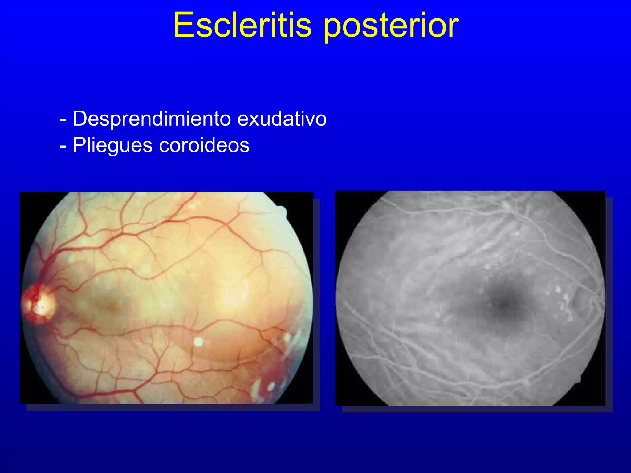 Oftalmologia - Escleritis Posterior | PPT | Eye and Vision Conditions ...