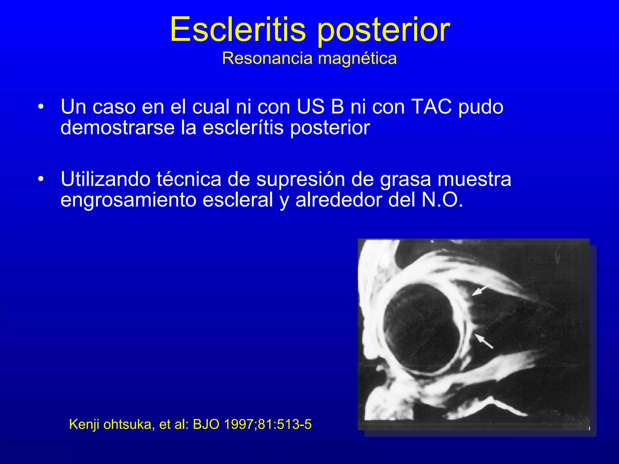 Oftalmologia - Escleritis Posterior | PPT | Eye and Vision Conditions ...
