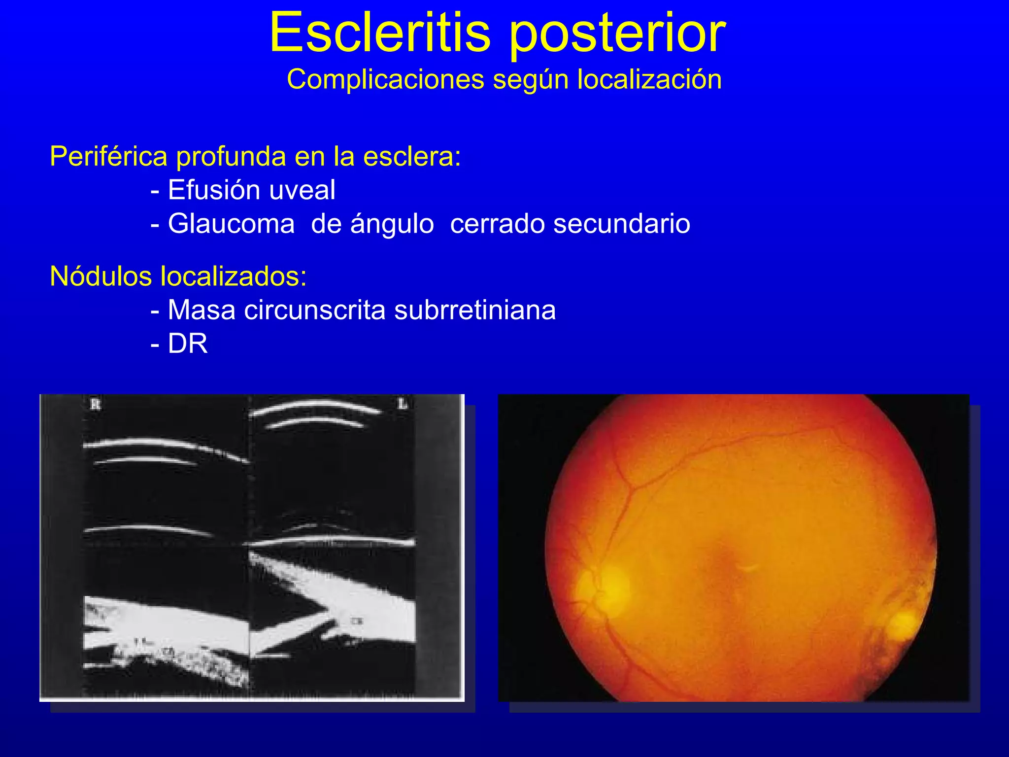 Oftalmologia - Escleritis Posterior | PPT | Eye and Vision Conditions ...
